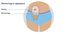 Apa Itu Stoma Bag? – National Pharmacy